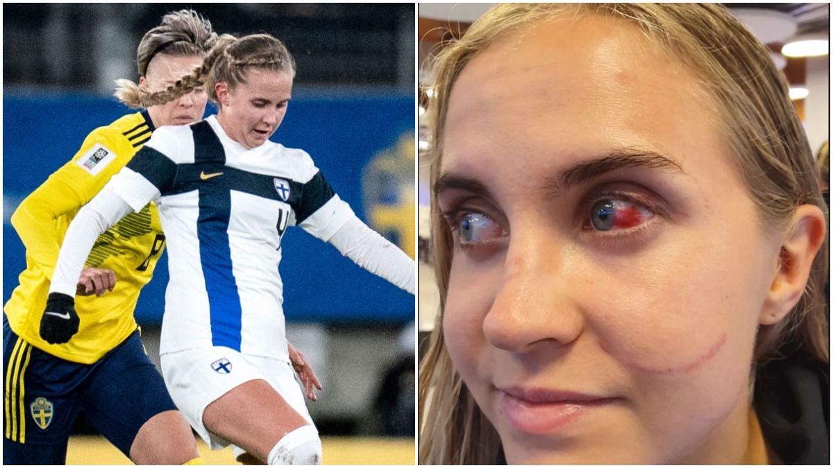 Female footballer shows gruesome eye injury from opponent’s fake nails