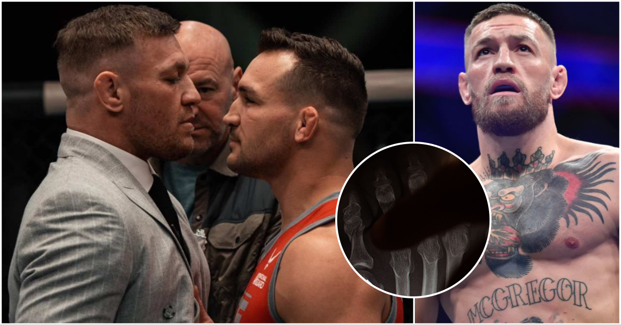 Conor McGregor Shares Photos of Injury Ahead of UFC 303