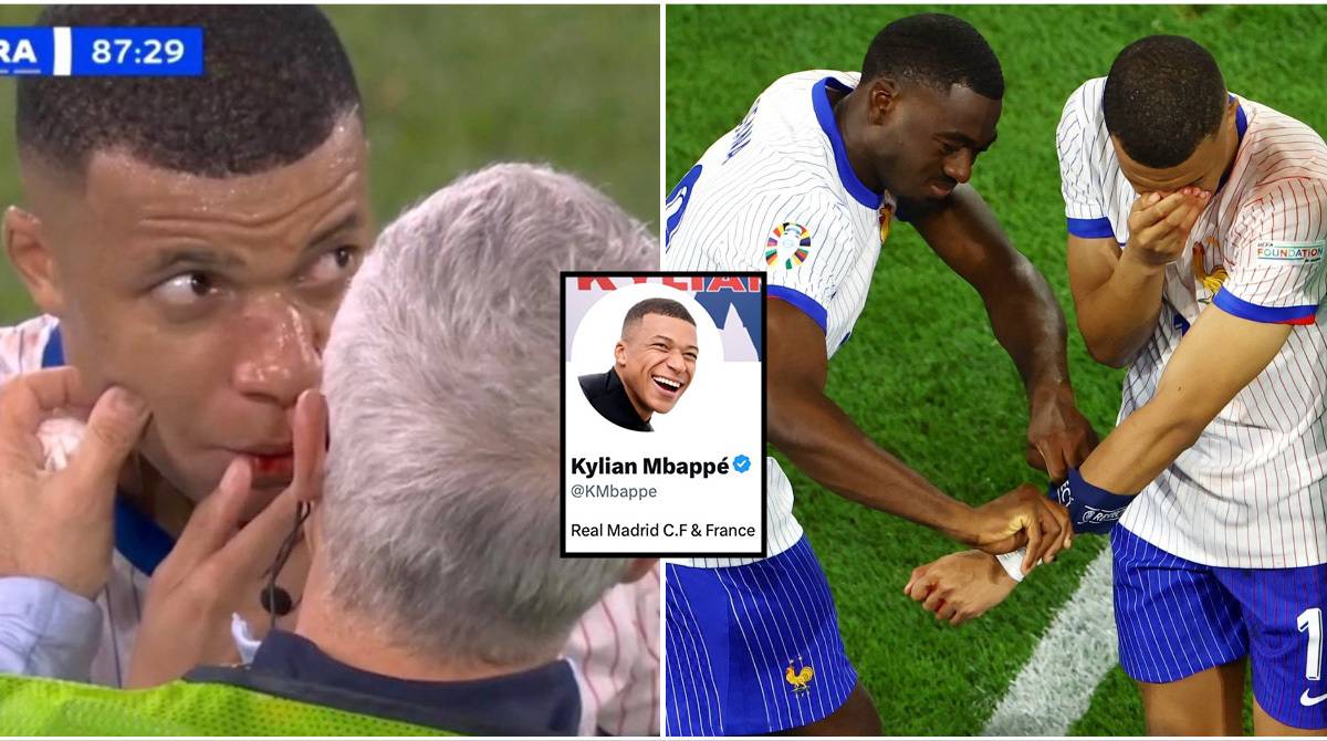 Kylian Mbappe Euro 2024 Injury Latest News