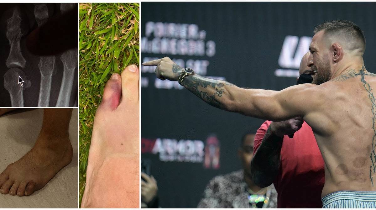 Conor McGregor Claims Treatment Made Broken Toe Worse