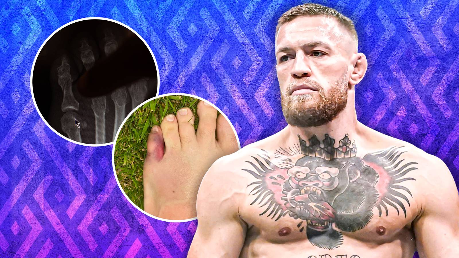 Conor McGregor Claims Treatment Made Broken Toe Worse