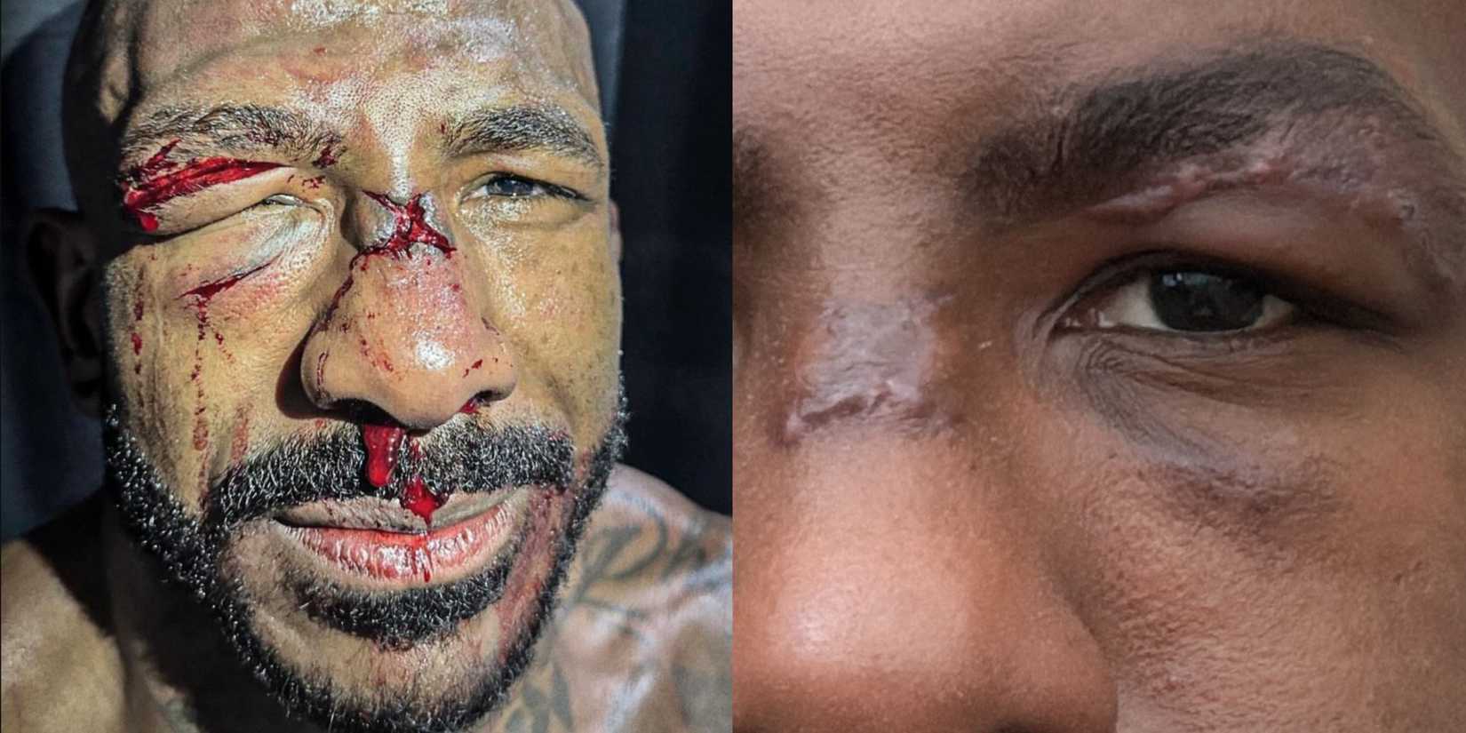Khalil Rountree's Facial Scars a Month After Alex Pereira Fight